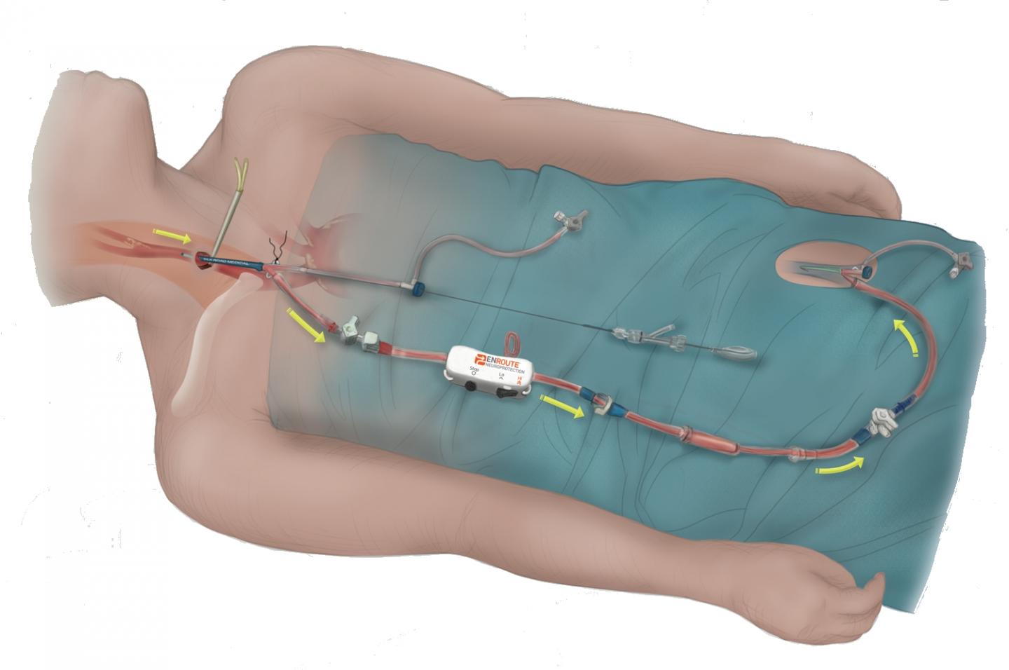 Vascular surgery research brings new options | EurekAlert!