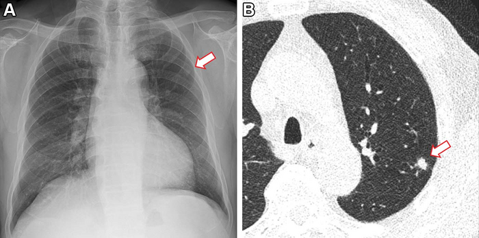 AI Improves Lung Nodule Detect [IMAGE] | EurekAlert! Science News Releases