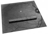 Restoring Eyesight with Gene Therapy (2 of 4) | EurekAlert!