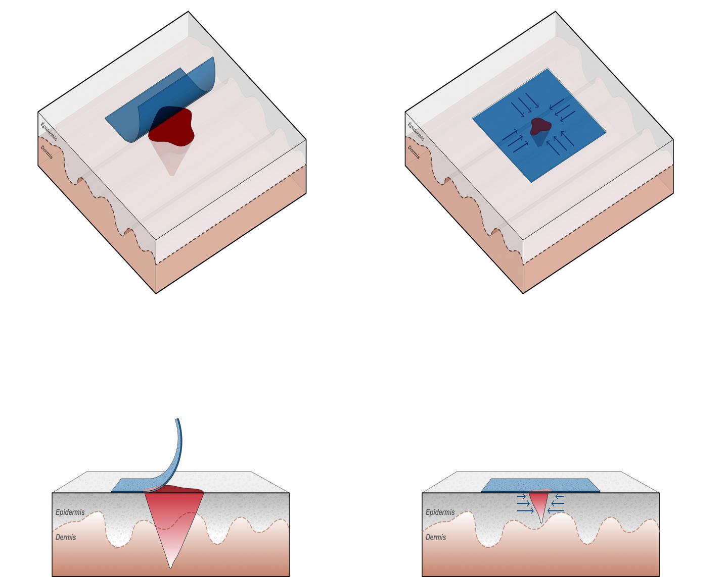 Wound Dressing Design Works Like Embryonic Sk | EurekAlert!
