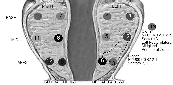 Prostate with Biospy Core Loca [IMAGE] | EurekAlert! Science News Releases