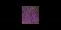 A one-two punch hits pancreatic cancer where | EurekAlert!