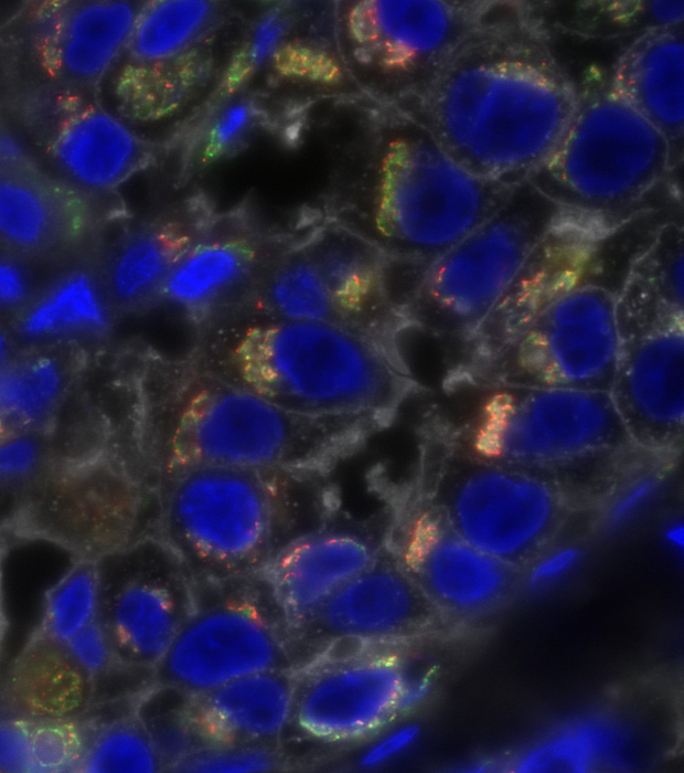 Analyzing Cancer Cells [IMAGE] | EurekAlert! Science News Releases