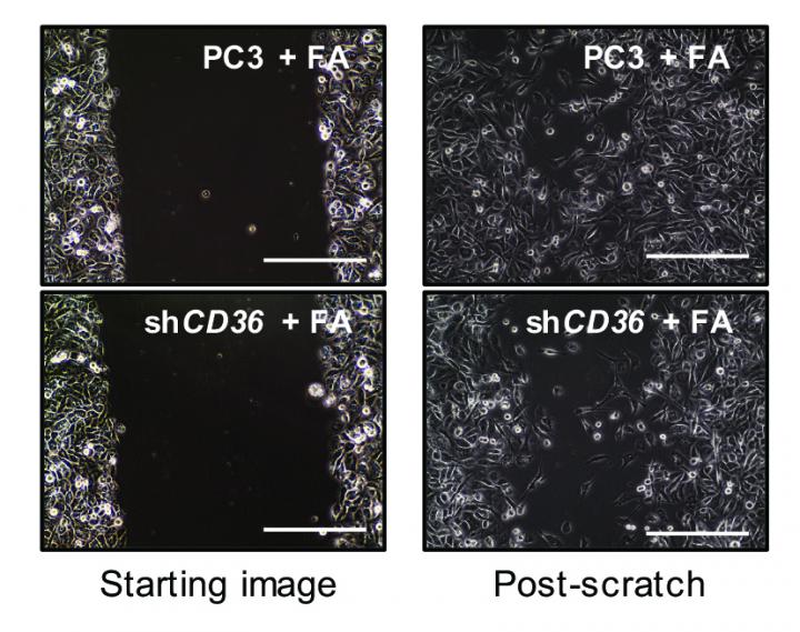 Trimming the Fat in the Treatment of Prostate | EurekAlert!