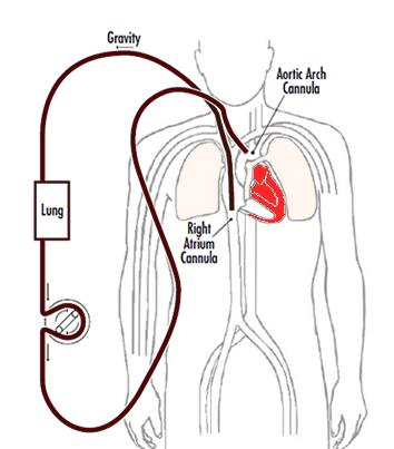 ECMO Diagram [IMAGE] | EurekAlert! Science News Releases