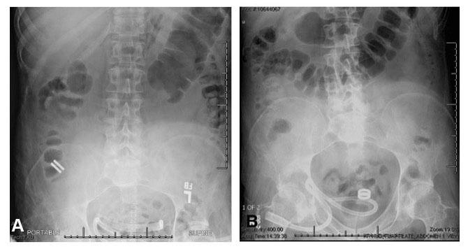 Magnetic Compression Anastomos [IMAGE] | EurekAlert! Science News Releases