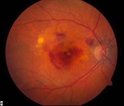 Neovascular AMD [IMAGE] | EurekAlert! Science News Releases