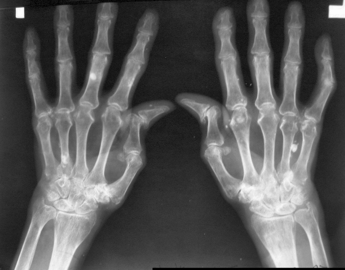 Novel study identifies key molecular players in rheumatoid arthritis ... Novel study identifies key molecular players in rheumatoid arthritis ...