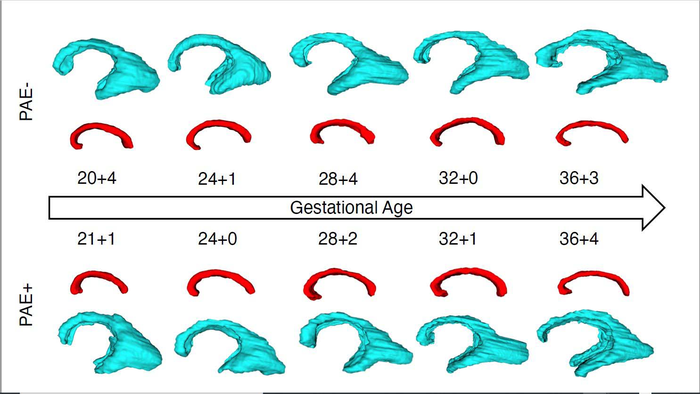 MRI Reveals Altered Brain Stru [IMAGE] | EurekAlert! Science News Releases