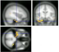 Changes in brain density can help predict sch | EurekAlert!