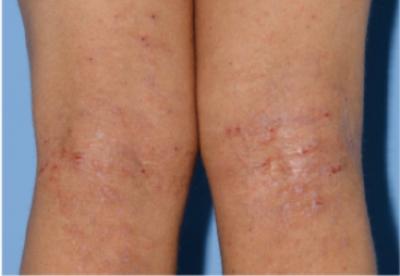 Human immune system shapes skin microbiome | EurekAlert!