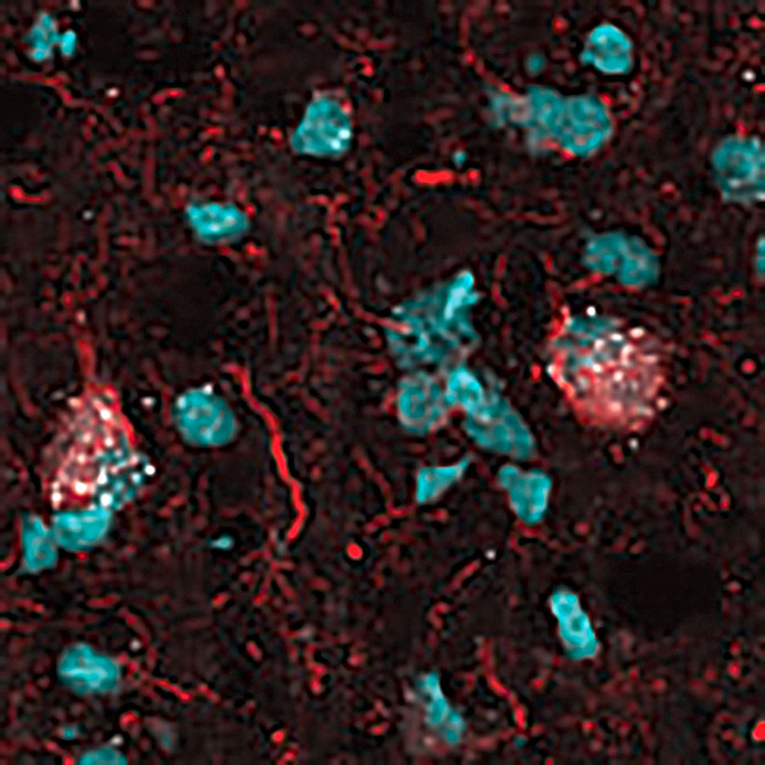 Scientists identify malfunctioning brain cell | EurekAlert!