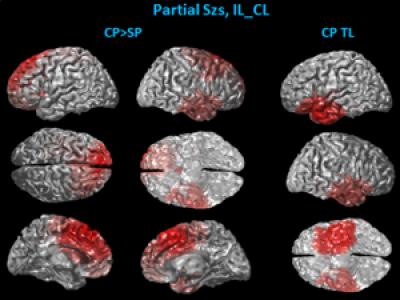 Brain Scans - Epilepsy Researc [IMAGE] | EurekAlert! Science News Releases
