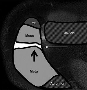 Acromial Apophyses [IMAGE] | EurekAlert! Science News Releases