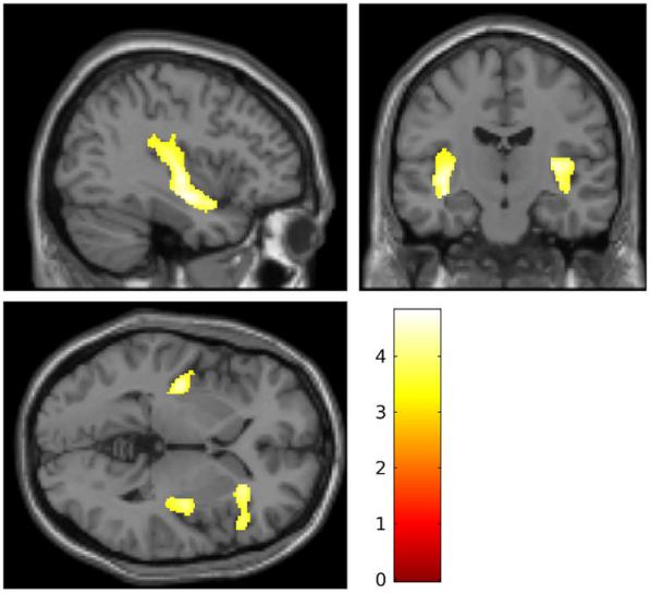 Borderline Personality Disorder Brain Vs Normal