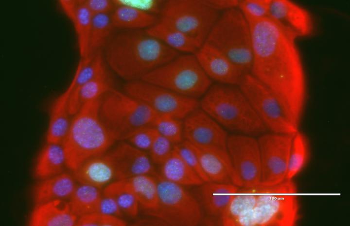 Pancreatic Cancer Patient-Deri [IMAGE] | EurekAlert! Science News Releases