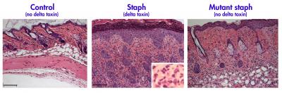 Staph Infection and Eczema [IMAGE] | EurekAlert! Science News Releases
