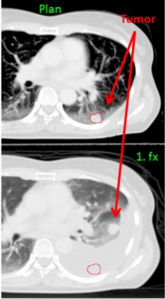 Lung Tumor Moves Position Betw [image] Eurekalert Science News Releases