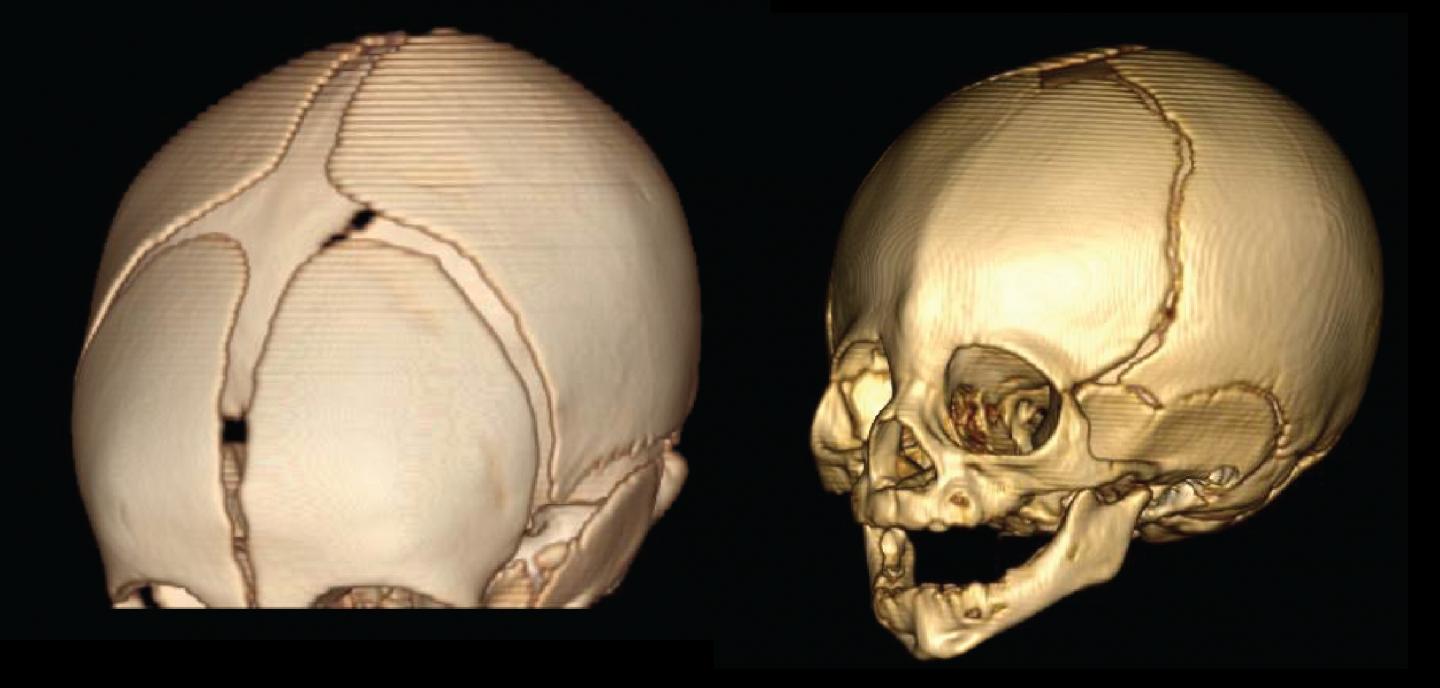 Rare And Common Genetic Variants Combine To C EurekAlert 