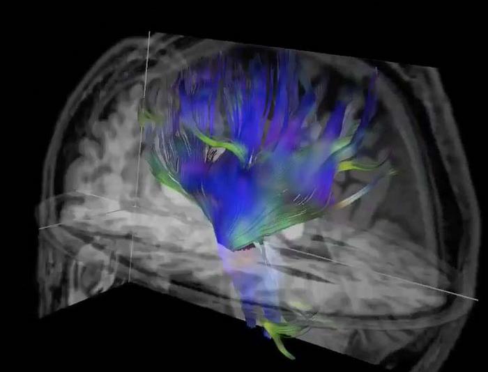 Diffusion tensor imaging of th [IMAGE] | EurekAlert! Science News Releases