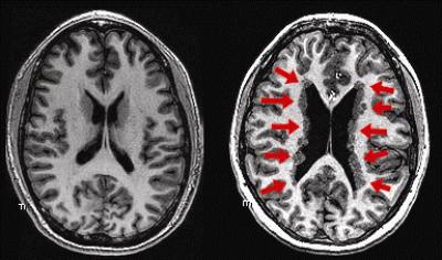 Slow reading in dyslexia tied to disorganized | EurekAlert!