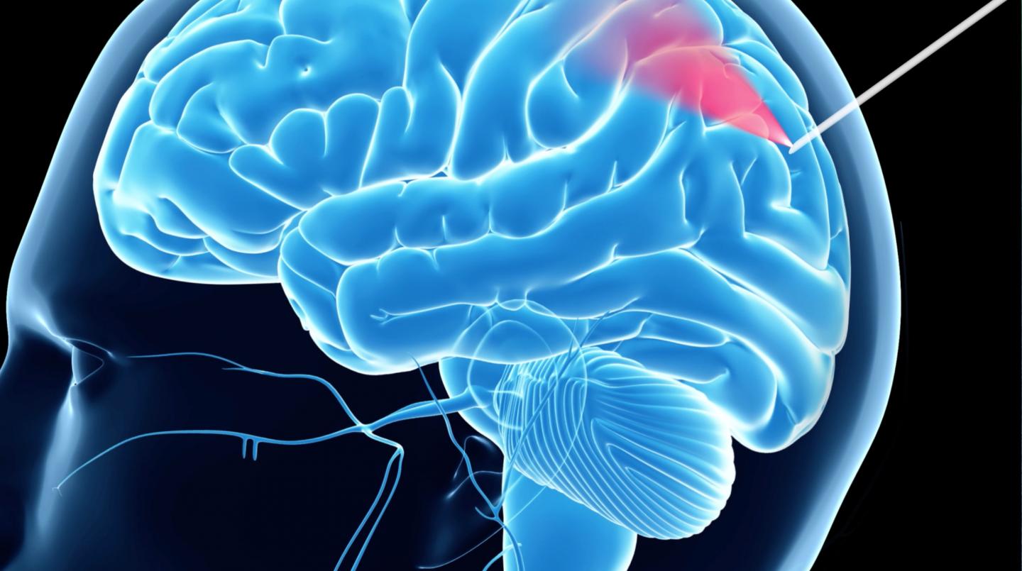 Imaging Needle Graphic [IMAGE] | EurekAlert! Science News Releases