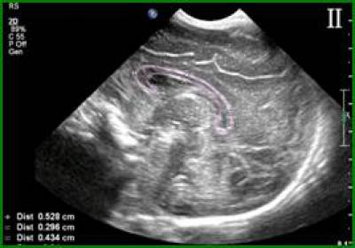 Is size of the corpus callosum a screening in | EurekAlert!