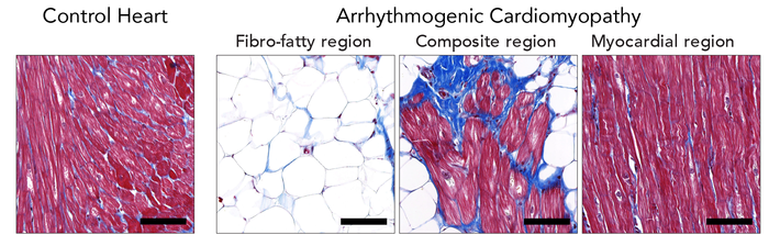 New gene identified in arrhythmogenic cardiom | EurekAlert!