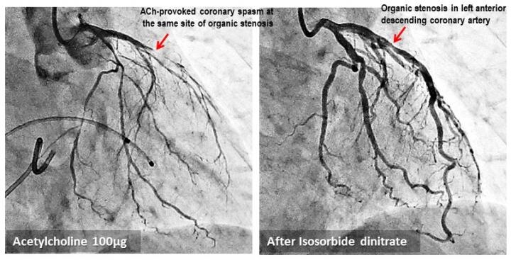 Spasm at site of atherosclerotic coronary art | EurekAlert!