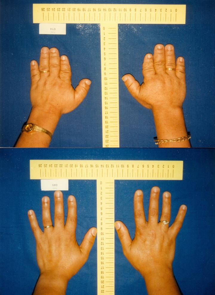 MDC and Charité researchers identify g | EurekAlert!