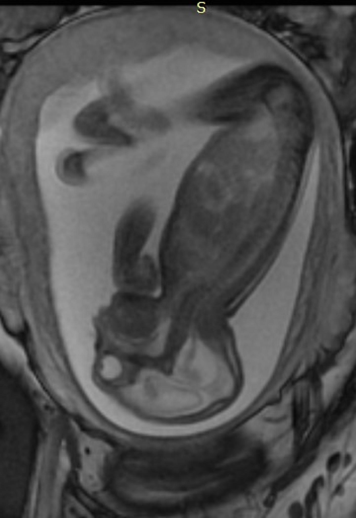 Figure 2: Side View of Fetus [IMAGE] | EurekAlert! Science News Releases