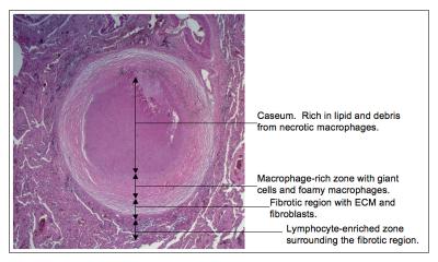 Fighting for Control of Tuberculosis (1 of 3) | EurekAlert!