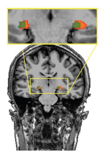 MRI of Human LGN [IMAGE] | EurekAlert! Science News Releases