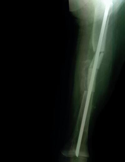 Long Bone Fracture of Individu [IMAGE] | EurekAlert! Science News Releases