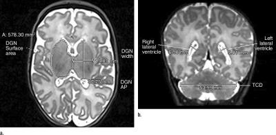 Deep Gray Nuclei [IMAGE] | EurekAlert! Science News Releases
