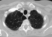 New gene linked to inherited lung disease via | EurekAlert!