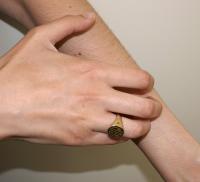 Scratching an Itch in Mice with New Small Mol | EurekAlert!