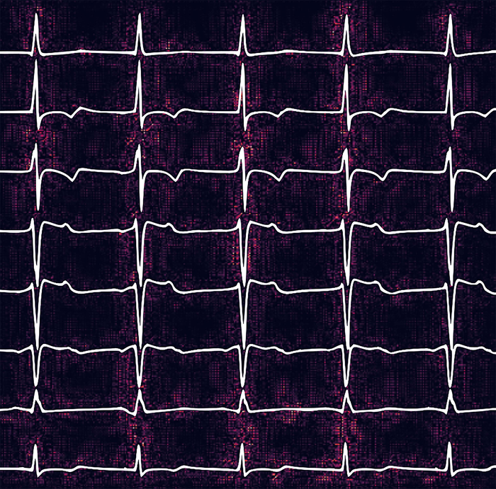 ECG-Reading AI Spots Hidden Si [IMAGE] | EurekAlert! Science News Releases