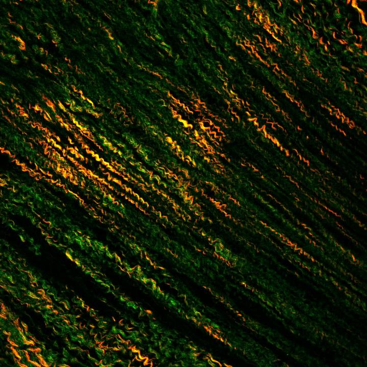 Straightening of Heart Attack [IMAGE] | EurekAlert! Science News Releases