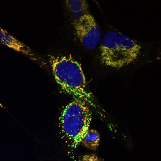 Brain Tumor Cells [IMAGE] | EurekAlert! Science News Releases