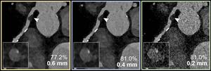 Photon-counting CT improves coronary artery d | EurekAlert!