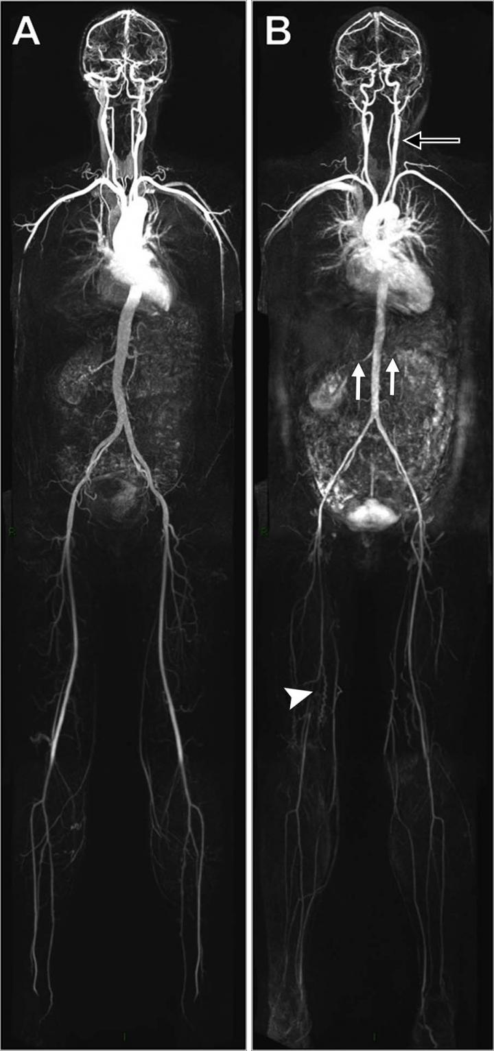 Examples of Whole-Body Angiogr [IMAGE] | EurekAlert! Science News Releases