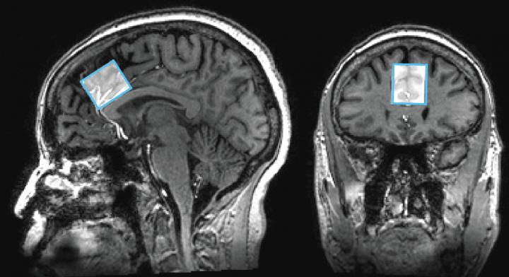 MRIs (1 of 2) [IMAGE] | EurekAlert! Science News Releases