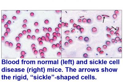 Normal vs. Sickle Cell Blood C [IMAGE] | EurekAlert! Science News Releases