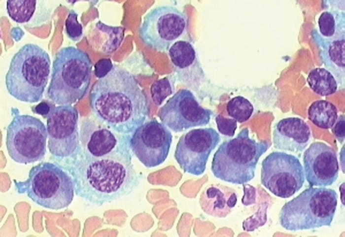 cell myeloma patient [IMAGE] | EurekAlert! Science News Releases