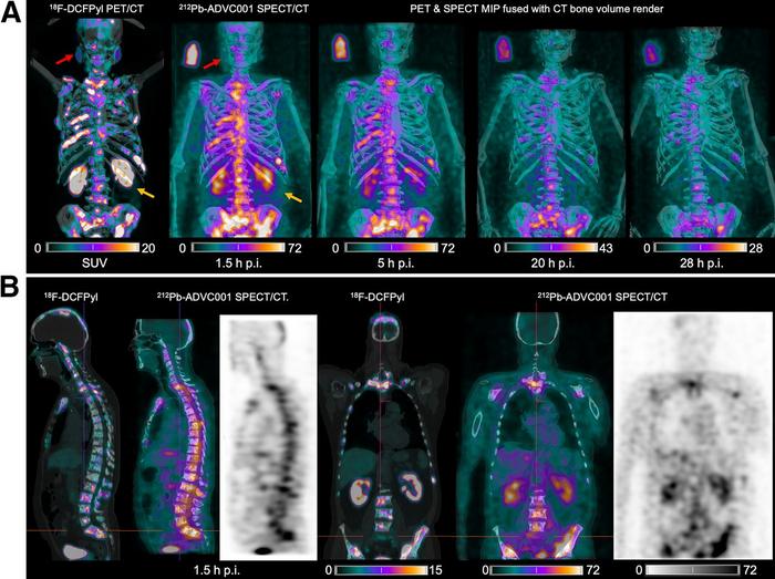 18F-DCFPyl PET/CT and 212Pb SP [IMAGE] | EurekAlert! Science News Releases