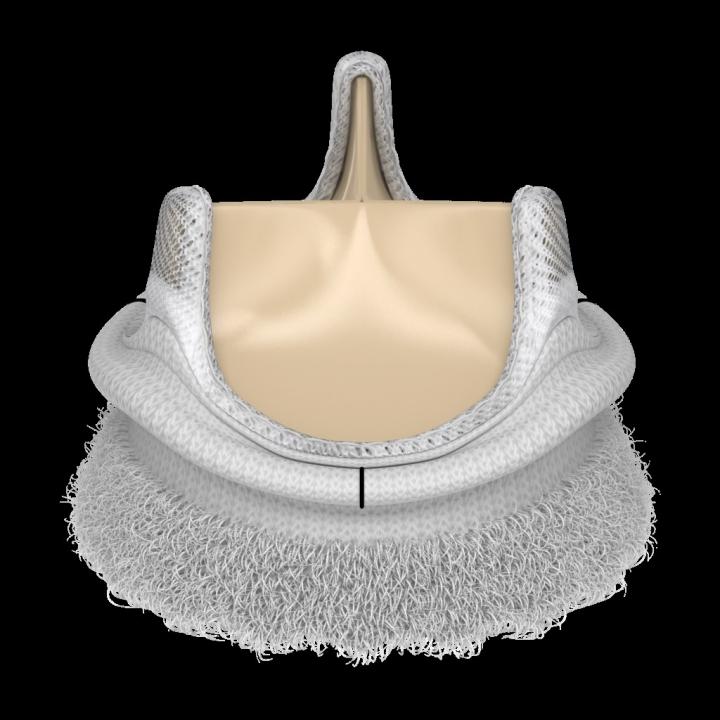 Implantation of rapid deployment aortic valve | EurekAlert!