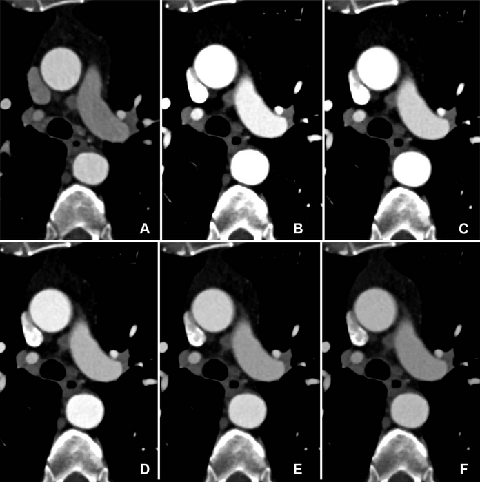 Photon-counting CT enables lower contrast med | EurekAlert!