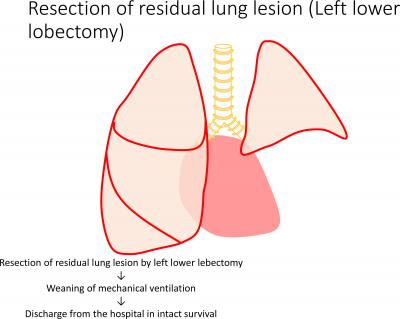 Resection of Lung Lesion [IMAGE] | EurekAlert! Science News Releases