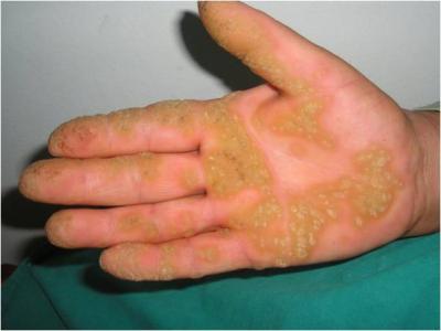 Lesions of Palmoplantar Kerato [IMAGE] | EurekAlert! Science News Releases